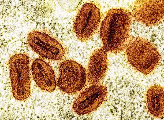 India: Suspected Mpox Case Under Investigation; Patient Stable and ...